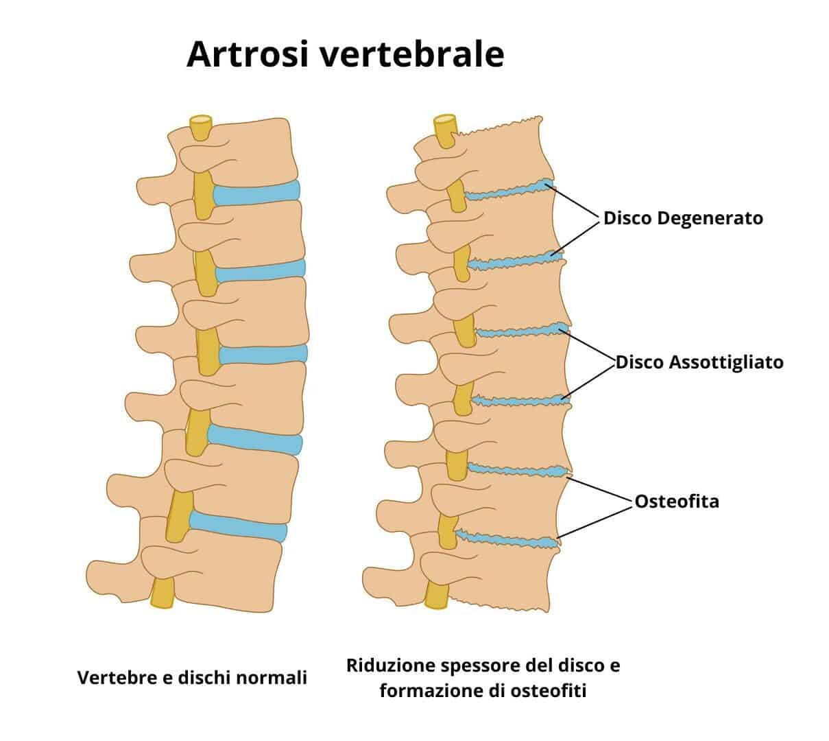 L’ARTROSI VERTEBRALE - Still Osteopathic Clinics